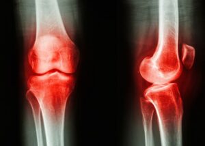 ¿Cómo Tratar La Artrosis De Rodilla En Fisioterapia? | Clínica Arias