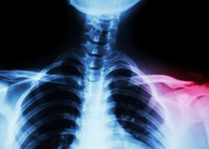 ¿Cómo se rehabilita la fractura de clavícula? | Clínica Arias